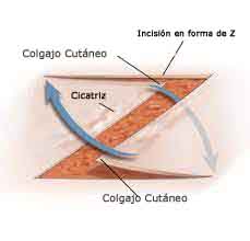 Cirugía Excisional | Centro Dermatológico Temuco